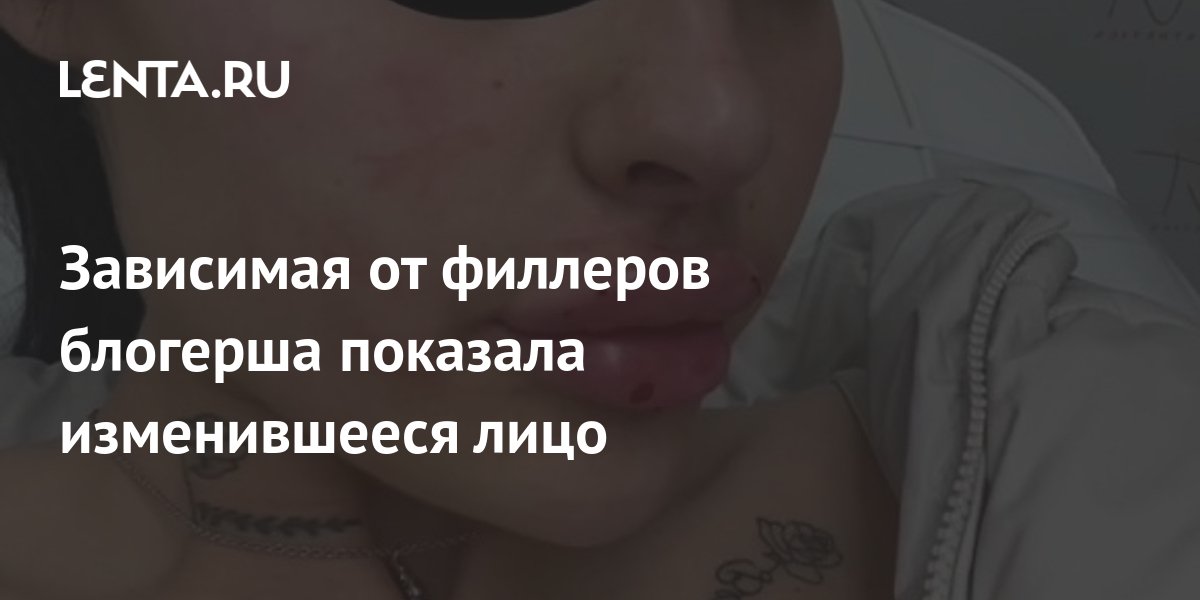 Зависимая от филлеров блогерша показала изменившееся лицо: Явления: Ценности: Lenta.ru